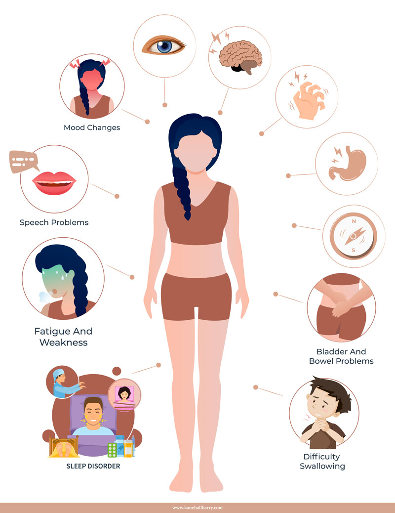 15 Early Signs Of Multiple Sclerosis Kane Hall Barry Neurology